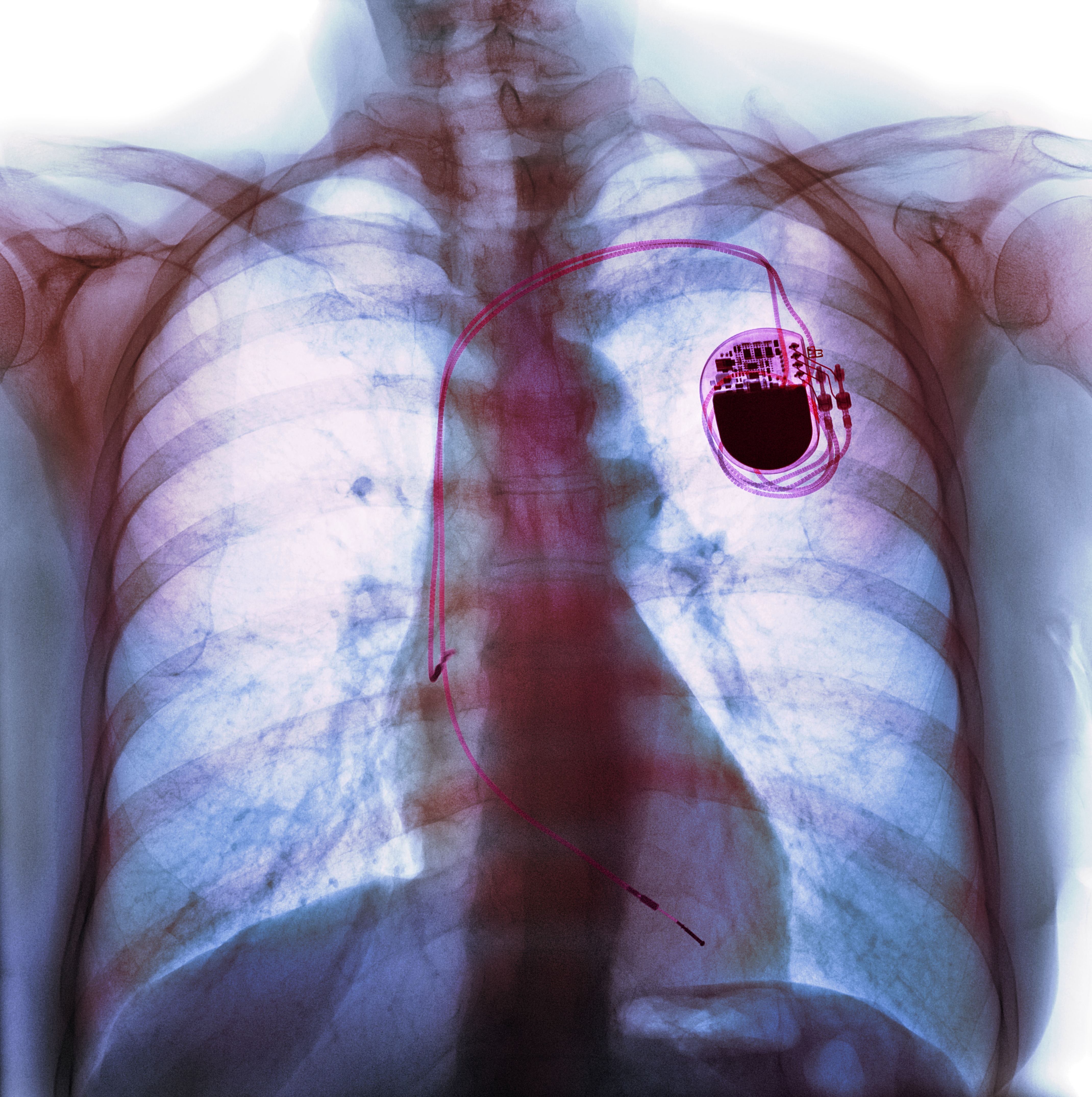 US FDA Determines PFAS Fluoropolymers in Medical Devices are Safe | SGS ...